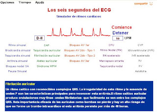 ARRITMIAS CARDIACAS (más frecuentes): Simulador de ritmos cardiacos ...