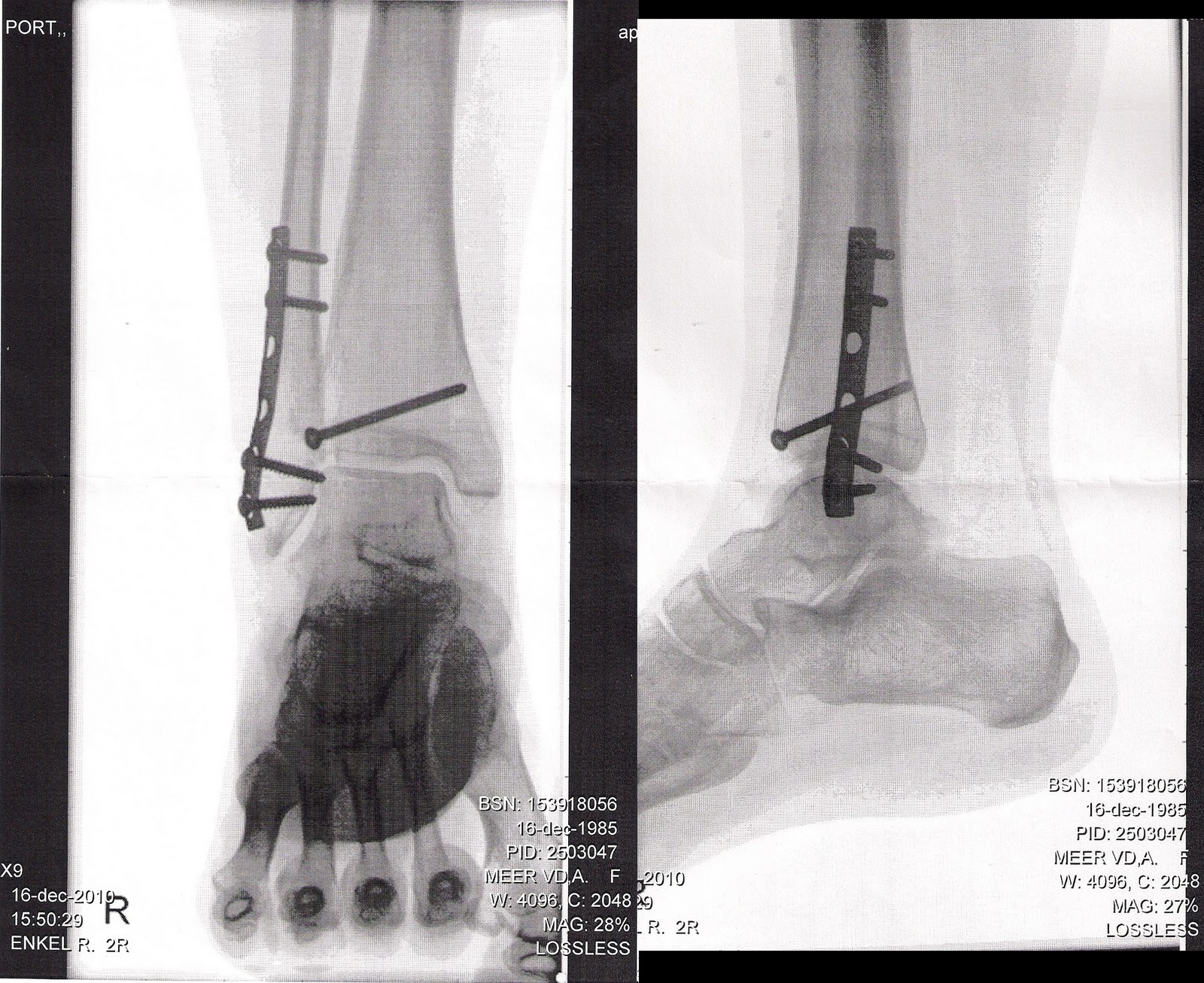 gipsverband.de - Annika van der Meer