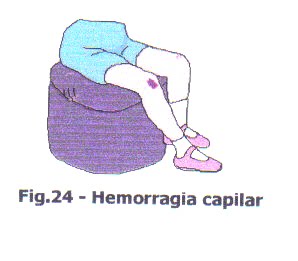 Primeiros Socorros: Hemorragias