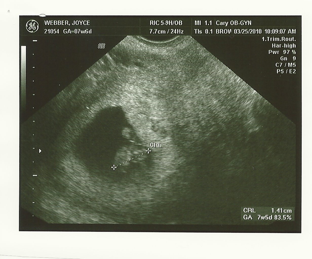 Two for One Special: 8 Week Ultrasound Pictures