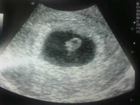 A Series of Firsts: Wordless Wednesday: 6w3d ultrasound!