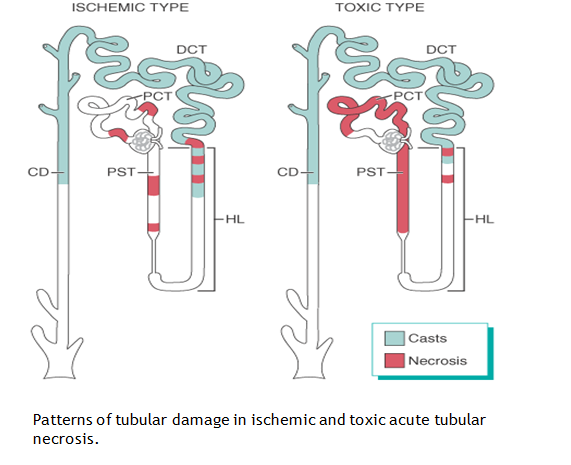 MBBS Medicine (Humanity First): Acute Tubular Necrosis (ATN).