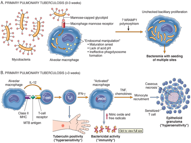 MBBS Medicine (Humanity First): Pathogenesis of TB.