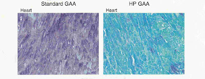 Pompe disease - the real story: Novazyme's results