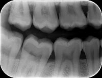 Primary Dental Care: New scenario - normal versus abnormal on bite wing ...