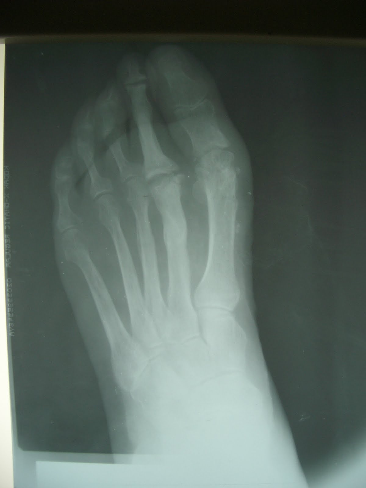 Podo Basas al Día: Hallux extensus iatrogénico. Köhler II iatrogénico o ...