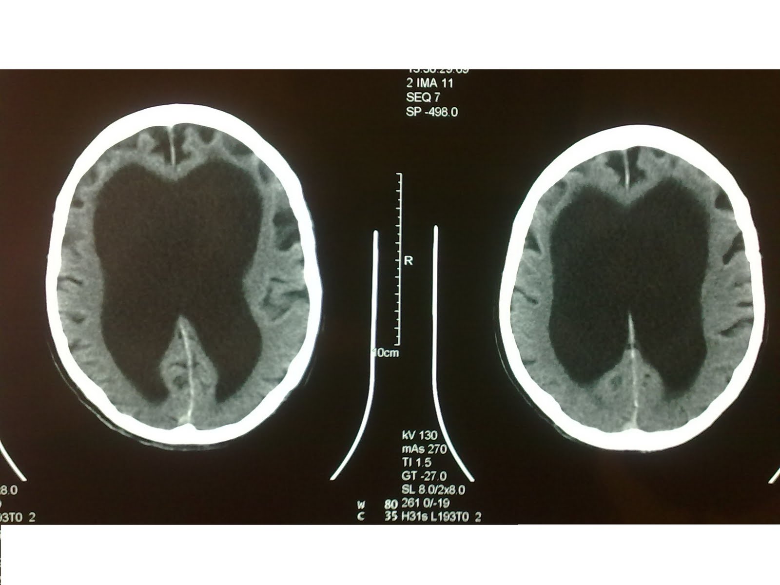 CLINICA DE GERIATRIA ON-LINE: HIDROCEFALIA EN ANCIANOS