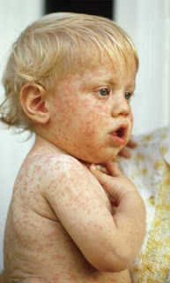 Medicoblog: Koplik Spots( Measles)
