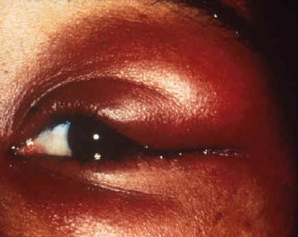 Doctorblog: SELULITIS ORBITA