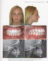 Babies and Braces: Class II - vertical maxillary excess, mandibular ...
