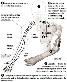 Prosthetic and Orthotic Studies: BIONIC ARM MECHANISM