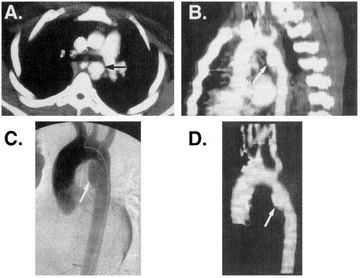 Medical Center: Blunt Aortic Injury