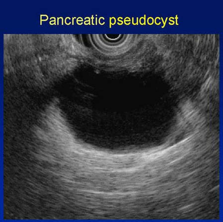 Medical Center: Pancreatic Pseudocyst
