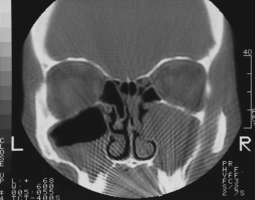 Medical Lecture Notes Online: Acute and Chronic Sinusitis