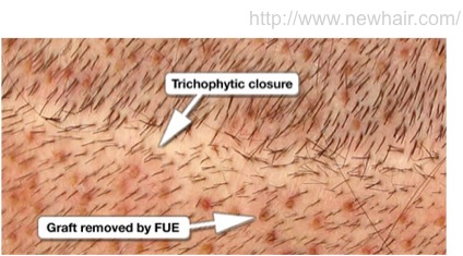 Good Bye Hair Loss - Hair Loss Tips & Advice Online: Trichophytic Closure
