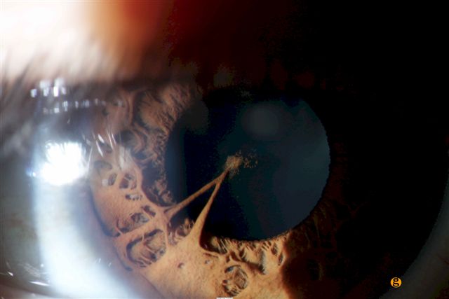 "Just Practicing": Cataract Zoo 5: Anterior Polar Cataract (with Iris ...
