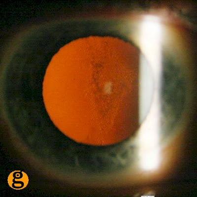 "Just Practicing": Cataract Zoo 3: Posterior Supcapsular