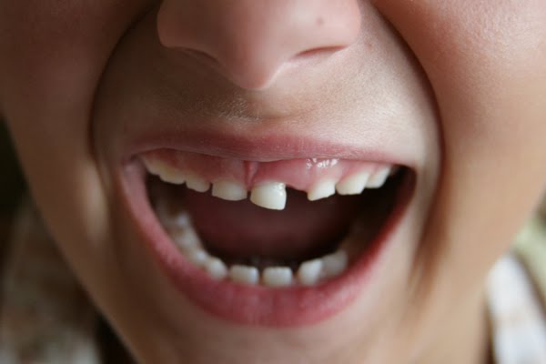 It is what it is...: ...another day and NO MORE WIGGLY TOOTH!