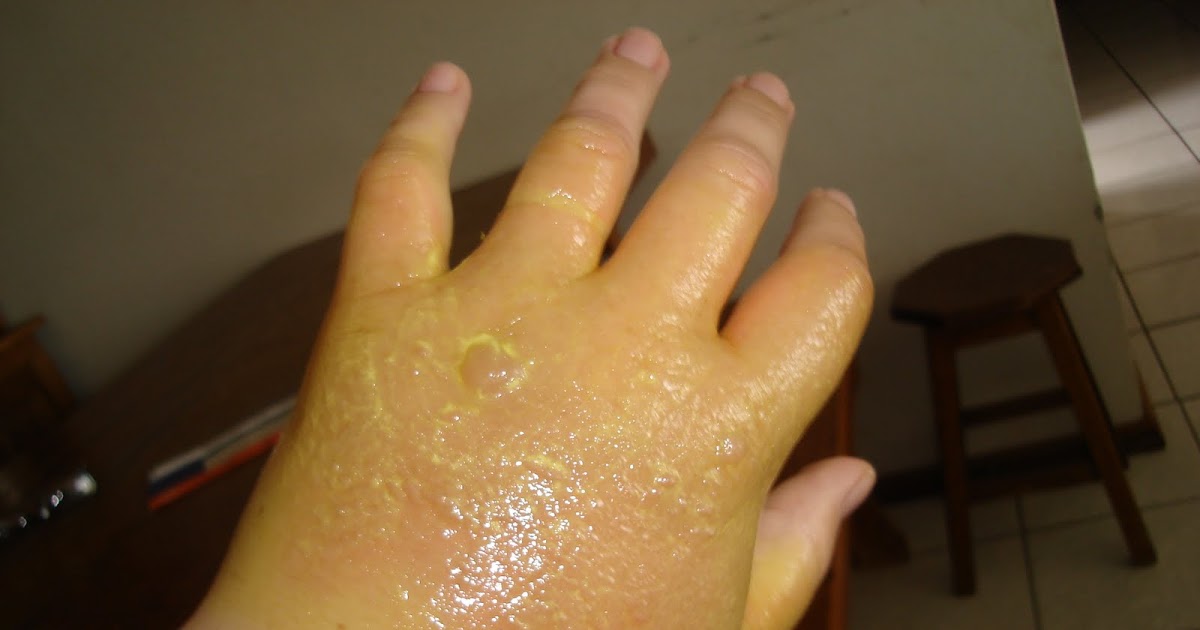 Pomada Para Queimadura Unguento Picrato De Butesin 100% Originalused ...