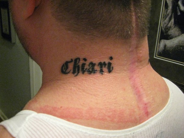 a bugg's eye view: A friend's fight with chiari malformation...