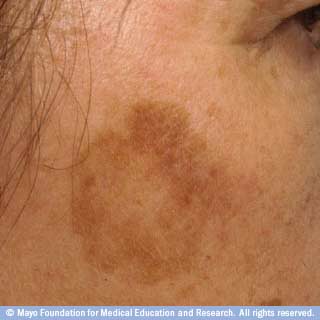 Healthy Life: Skin problems (2) : Sun Damage