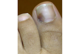 Healthy Life: Diseases of the Nails