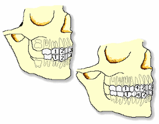 NEWSMILE-TACNA: DENTICION TEMPORAL Y DENTICION DEFINITIVA