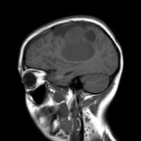 Rob's Radiology: Pleomorphic Xanthoastrocytoma