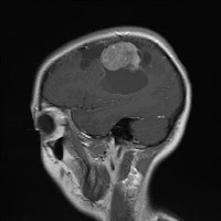 Rob's Radiology: Pleomorphic Xanthoastrocytoma