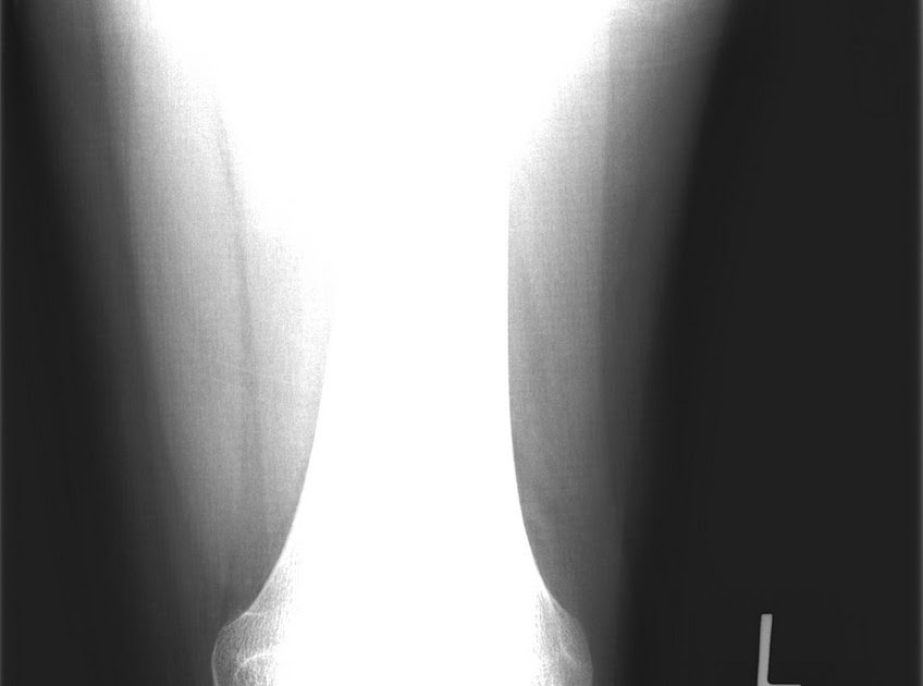 Rob's Radiology: The Arcuate Sign