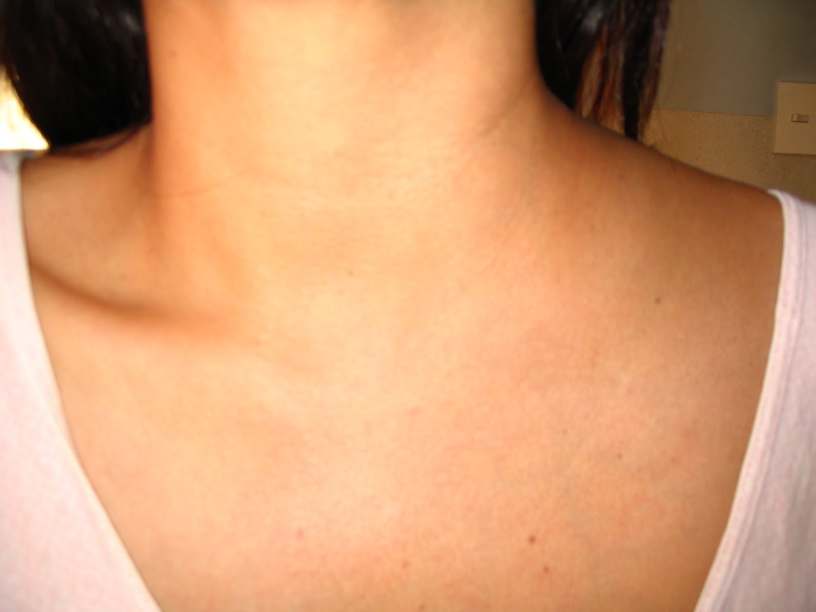 Ganglios Linfáticos Supraclaviculares Inflamados