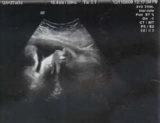 Seeking Sunshine: Ultrasound - 37 weeks 3 days