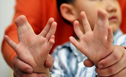 TYWKIWDBI ("Tai-Wiki-Widbee"): Extraordinary polydactyly