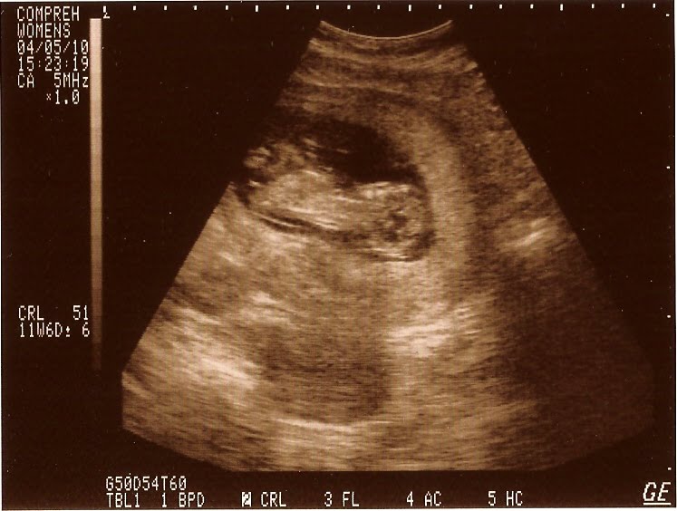 Bouge Crew Blog: Sonogram #2: 3 Months in!
