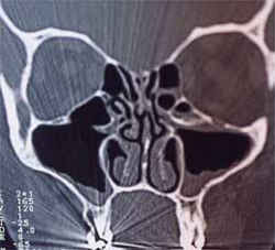 CT/MRI Pathologies: Chronic Sinusitis
