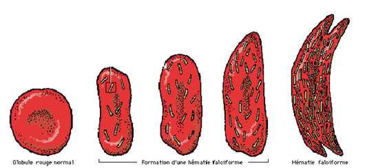la drépanocytose