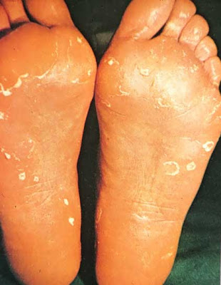 Shenandoah Podiatry: Tinea Pedis