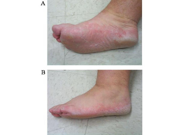 Shenandoah Podiatry: Tinea Pedis