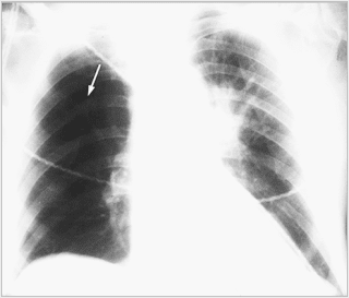 Embolia Pulmonar: EMBOLIA PULMONAR