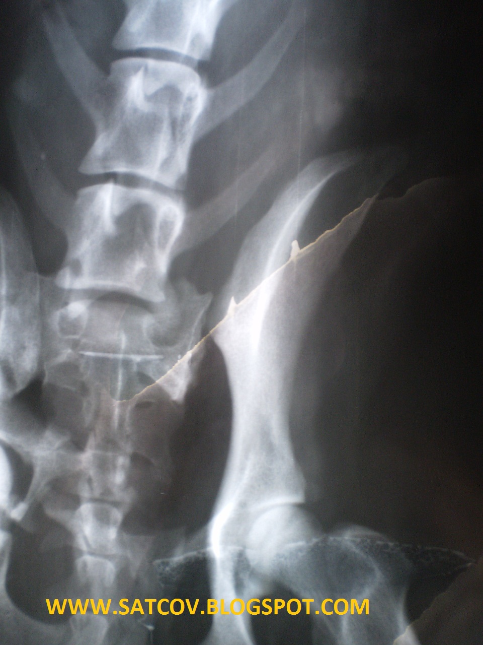 Traumatologia y Cirugia Ortopedica Veterinaria: FRACTURA DE CADERA EN PERRO