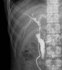 estudios contrastados: Colangiografia Post-operatoria