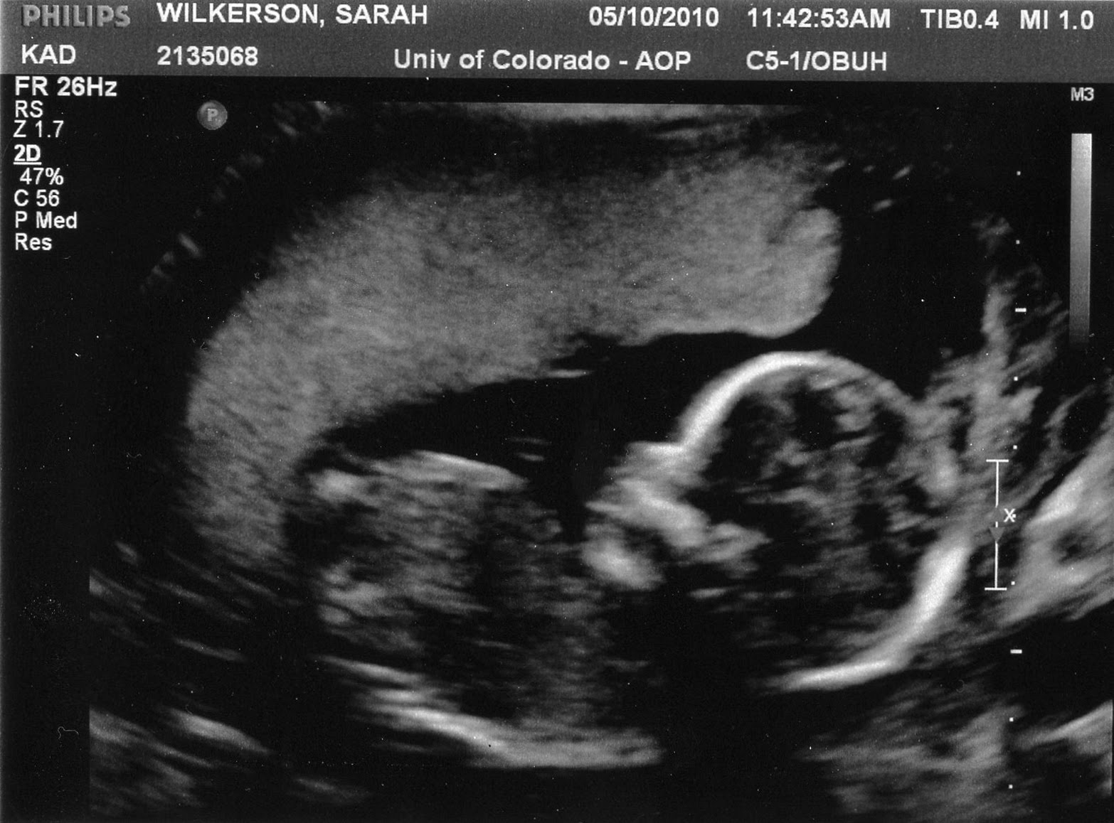 Wilkerson Baby Blog: Amniocentesis
