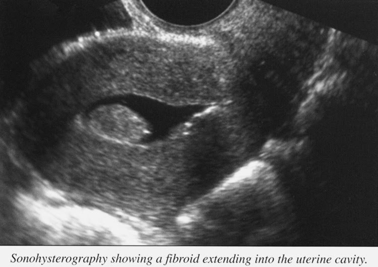 100 Questions & Answers about Infertility - DrG's Fertility Blog: March ...