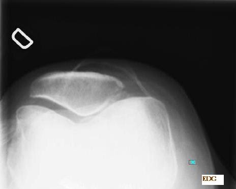 Técnicas Radiológicas y Avances: Radiografia axial rodilla