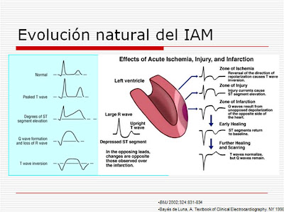 Educación Médica Continua: IAM EKG