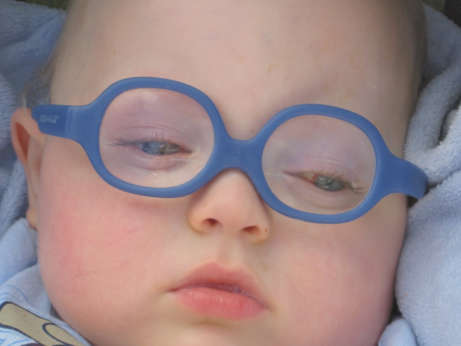 Bryce Alexander Moline: Post Surgery...eyes