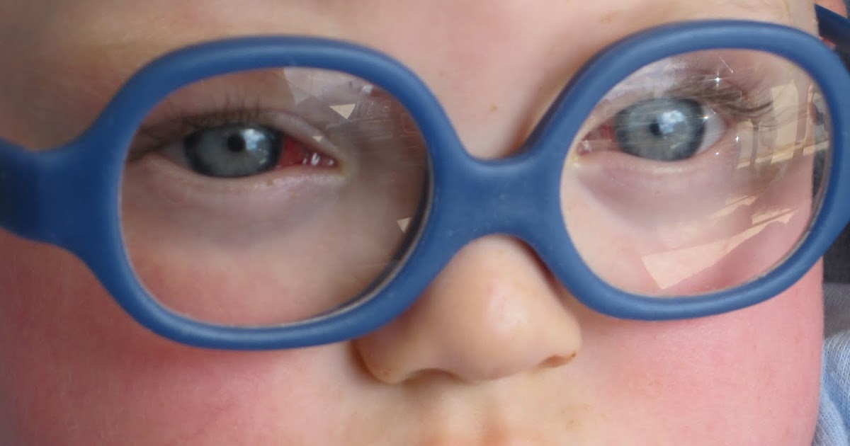 Bryce Alexander Moline: Post Surgery...eyes