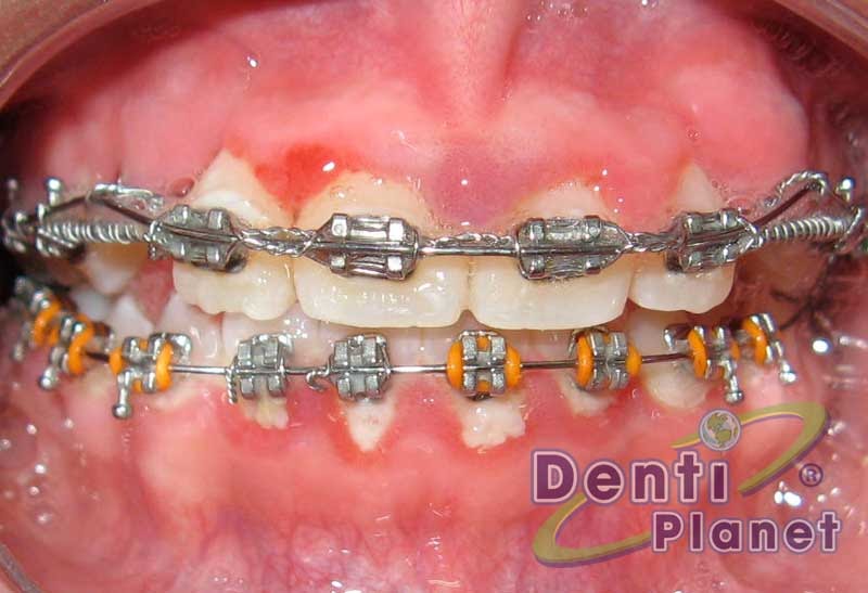 Blog Ortodoncia Dentiplanet: Problemas con los brackets , aunque cuide ...