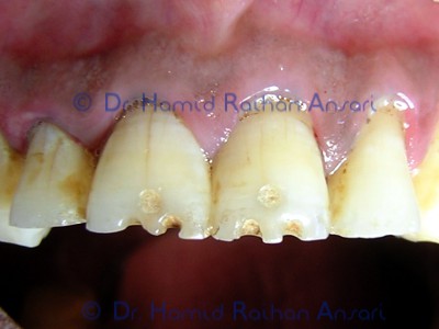 Discovering Dentistry: What is the cause of this central incisor notching?