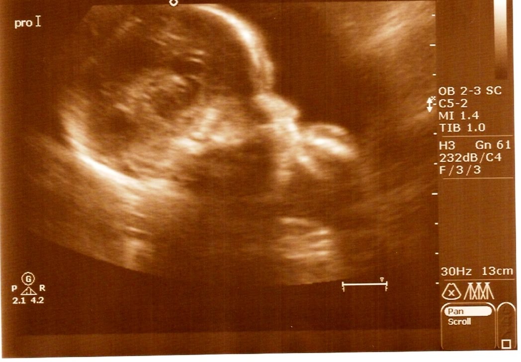 Expecting: New Ultrasound photos